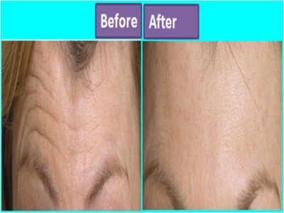 How to Get Rid of Forehead Wrinkles