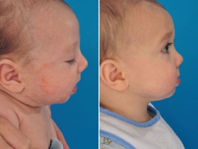 How to Treat Pierre Robin Syndrome