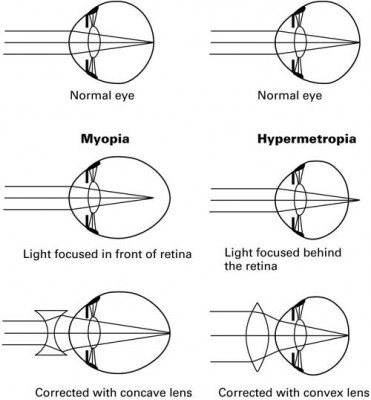 Difference between Hyperopia and Myopia