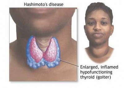 How to Recognize Synthroid Side Effects