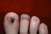 How to Treat a Bruised Toenail
